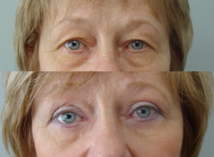 BLEFAROPLASTIKA / Korekcija vjeđa - Estetska kirurgija glave i vrata ...